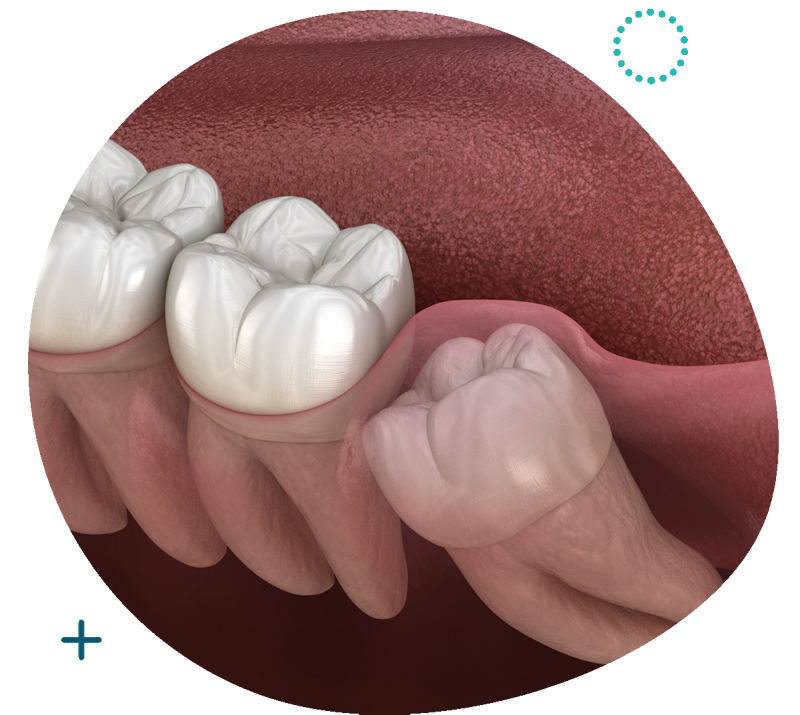 Wisdom Tooth Surgery - The Braces Practice