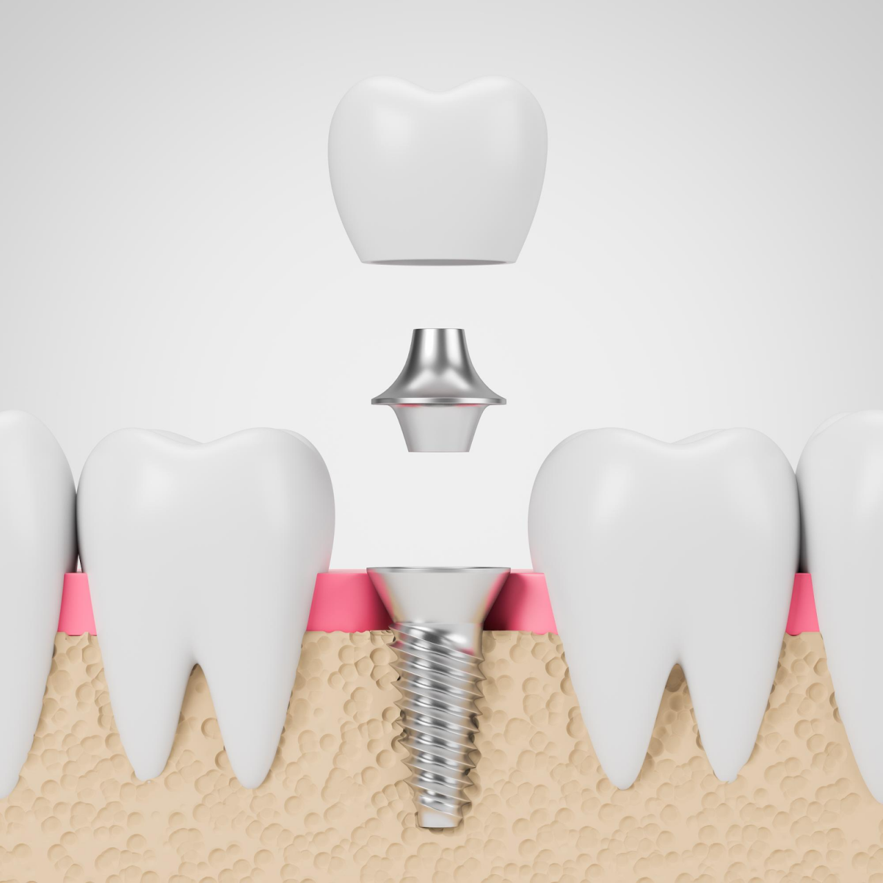 What is Dental Tooth Crown? Everything You Need To Know - The Braces ...