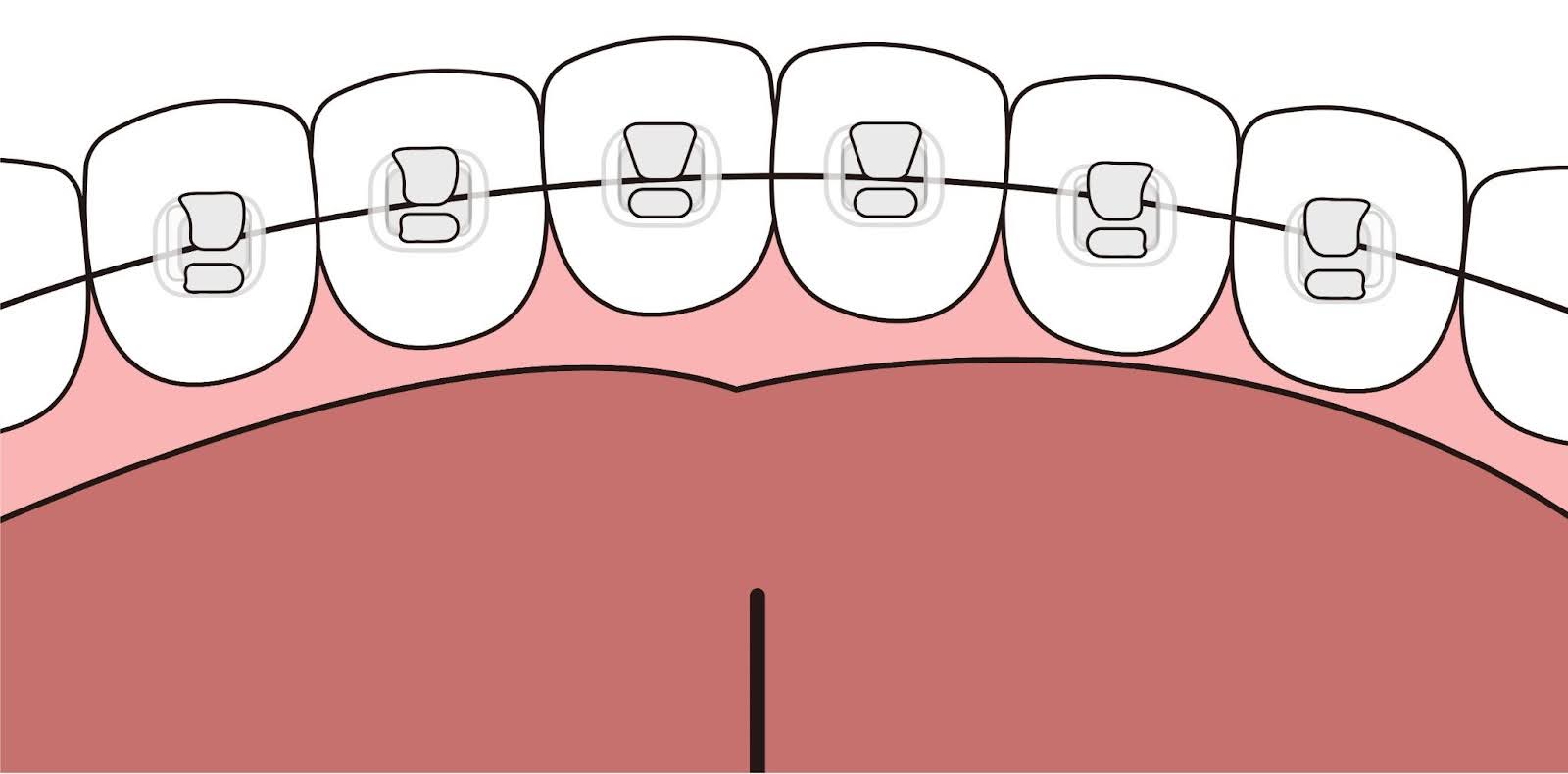 A Guide To Clear Dental Braces In Singapore - The Braces Practice