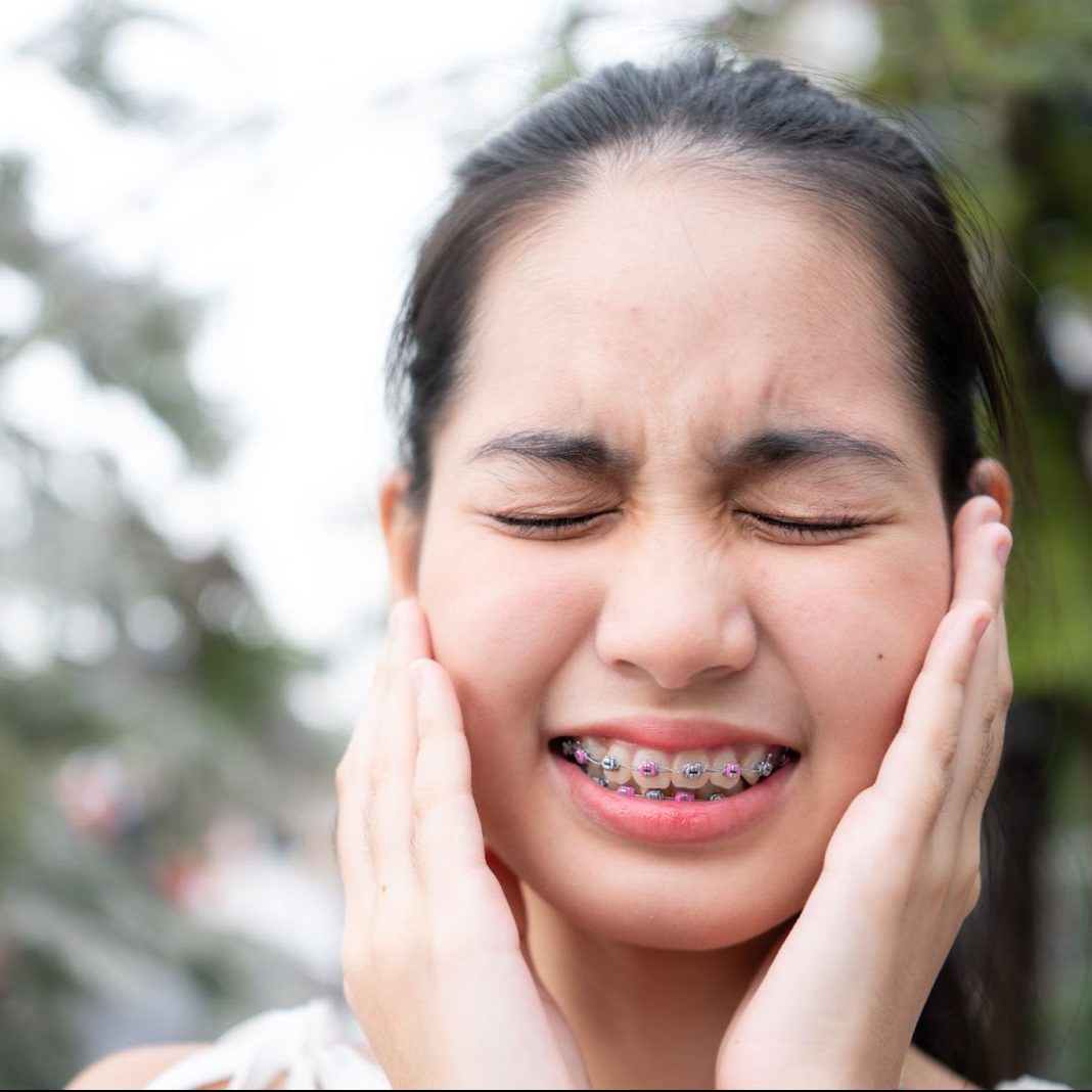 Tooth Extraction For Braces: Do You Need It? - The Braces Practice